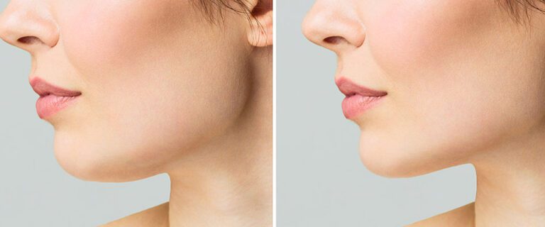 Tratamento para papada – Dra. Mariana Weber