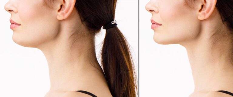 Tratamento para papada – Dra. Mariana Weber